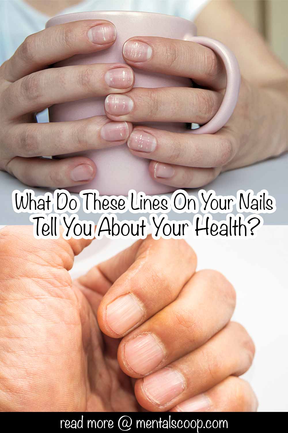 What Do These Lines On Your Nails Tell You About Your Health? - Mental ...